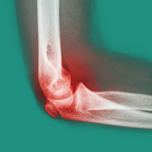 Épicondylite Épitrochléite Douleur Coude - Mésothérapie Articulaire